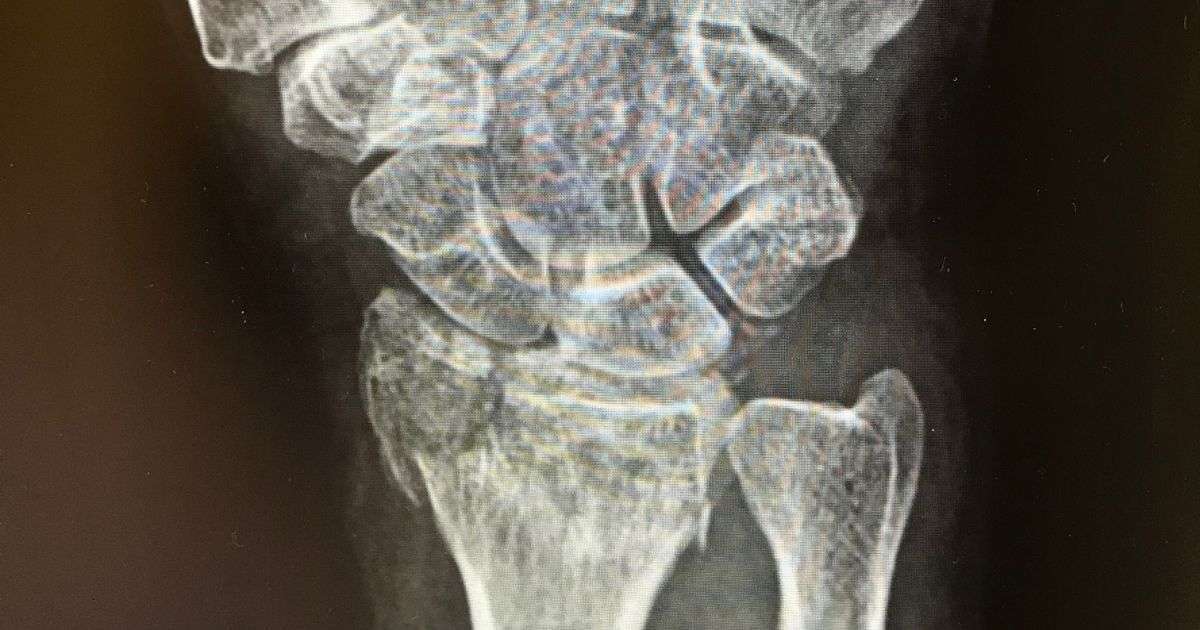 Distal Radius Fractures: Do They All Need Occupational Therapy ...
